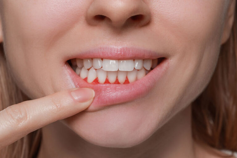 Learn More About Receding Gums and What They Mean | West Bowmanville ...